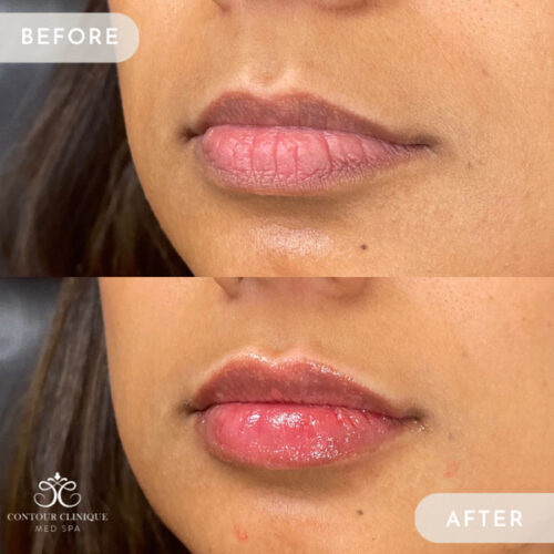 Lip Pump - Contour Clinique Med Spa