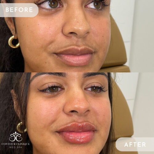 Lip Pump - Contour Clinique Med Spa