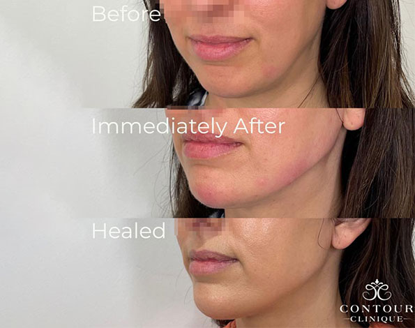 Jawline Fillers | Contour Clinique Med Spa