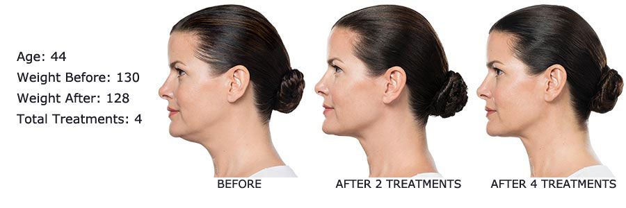 KYBELLA® | Contour Clinique Med Spa