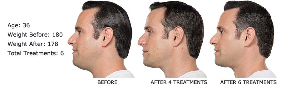 KYBELLA® | Contour Clinique Med Spa