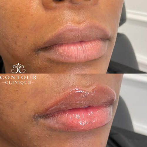Lip Fillers in Westchase, FL | Contour Clinique Med Spa