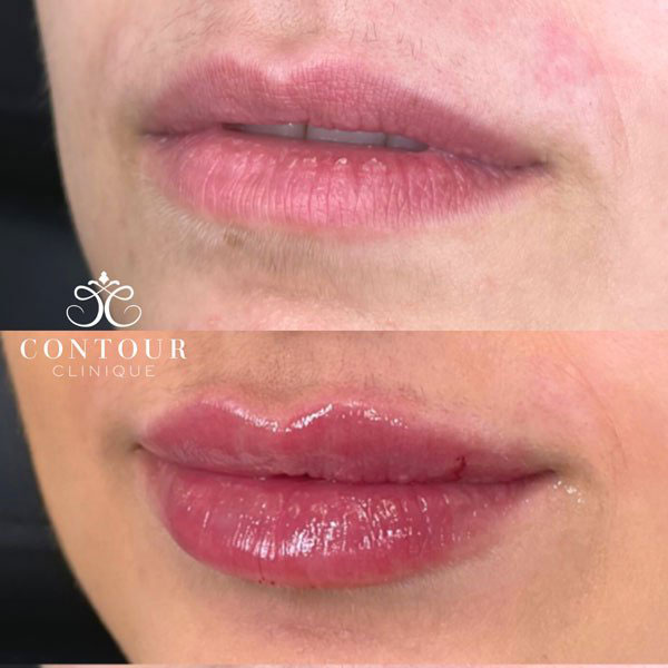 Lip Fillers in Westchase, FL | Contour Clinique Med Spa