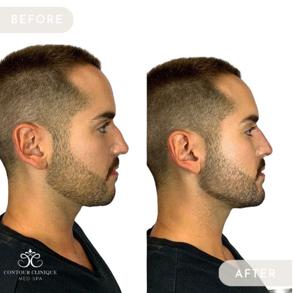 Full Face AKA Beautification/Masculinization | Contour Clinique Med Spa