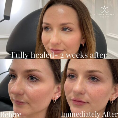 Under Eye Fillers | Contour Clinique Med Spa